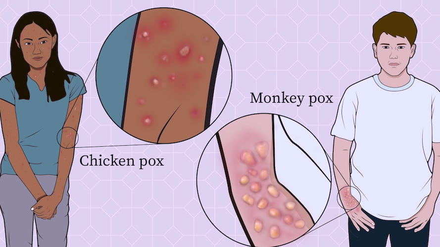 beda cacar monyet dan cacar air